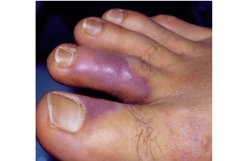 Core Concepts - Cutaneous Manifestations - Basic HIV Primary Care ...