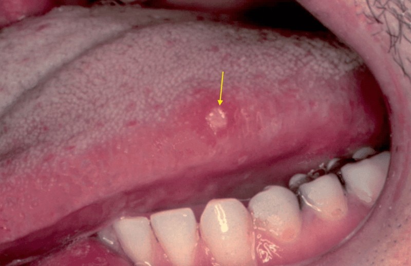 Core Concepts - Oral Manifestations - Basic HIV Primary Care - National ...