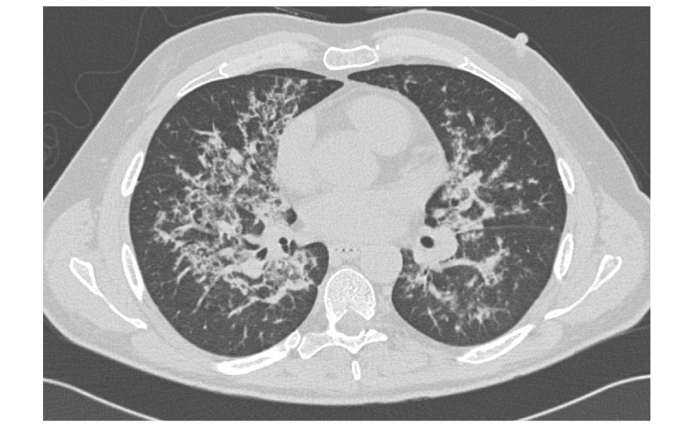Core Concepts - Opportunistic Infections: Treatment - Co-Occurring ...