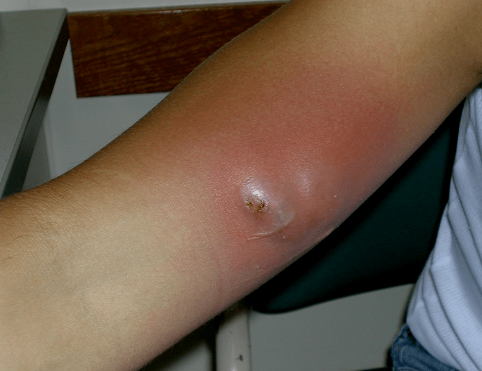 Core Concepts - Cutaneous Manifestations - Basic HIV Primary Care ...