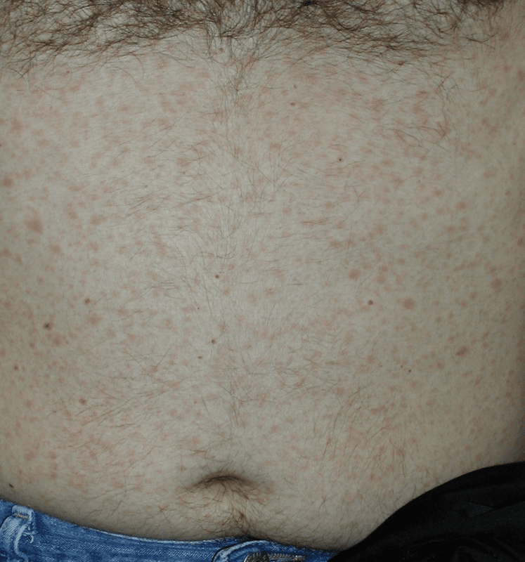 Core Concepts - Sexually Transmitted Infections - Co-Occurring ...