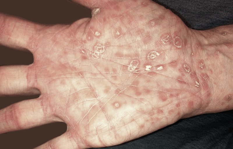 Core Concepts - Sexually Transmitted Infections - Co-Occurring ...