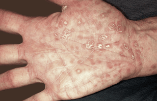 Core Concepts - Sexually Transmitted Infections - Co-Occurring ...