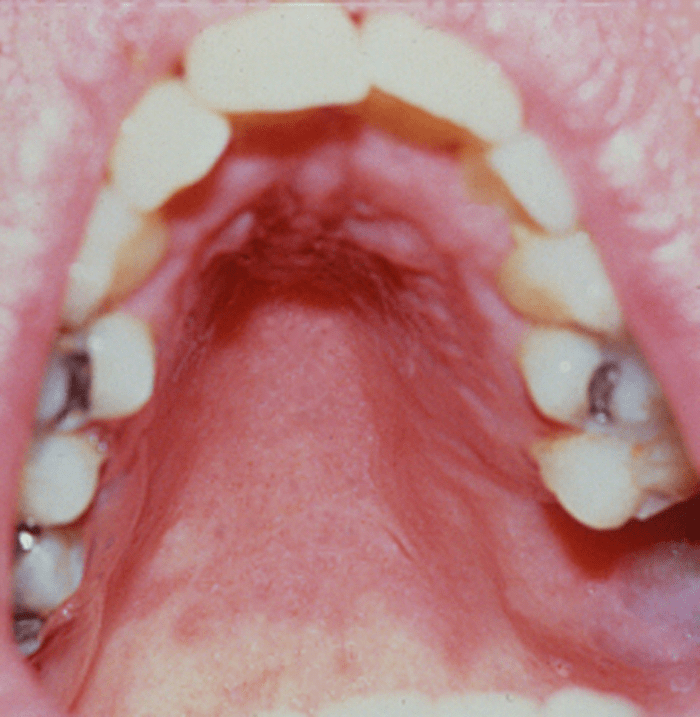 Question 2 - Oral Manifestations Question Bank - National HIV Curriculum
