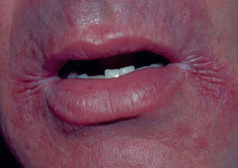Core Concepts - Oral Manifestations - Basic HIV Primary Care - National ...