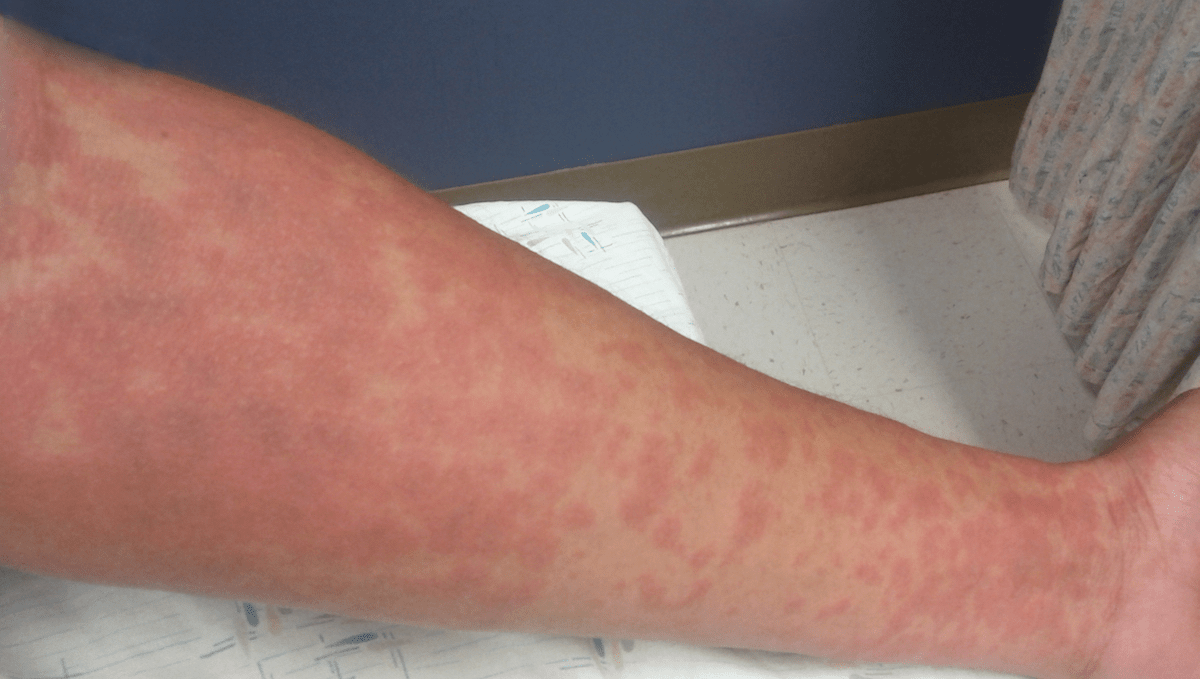 Core Concepts - Adverse Effects of Antiretroviral Medications ...