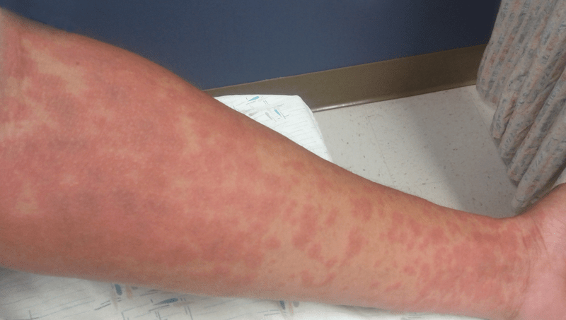 Core Concepts - Adverse Effects of Antiretroviral Medications ...