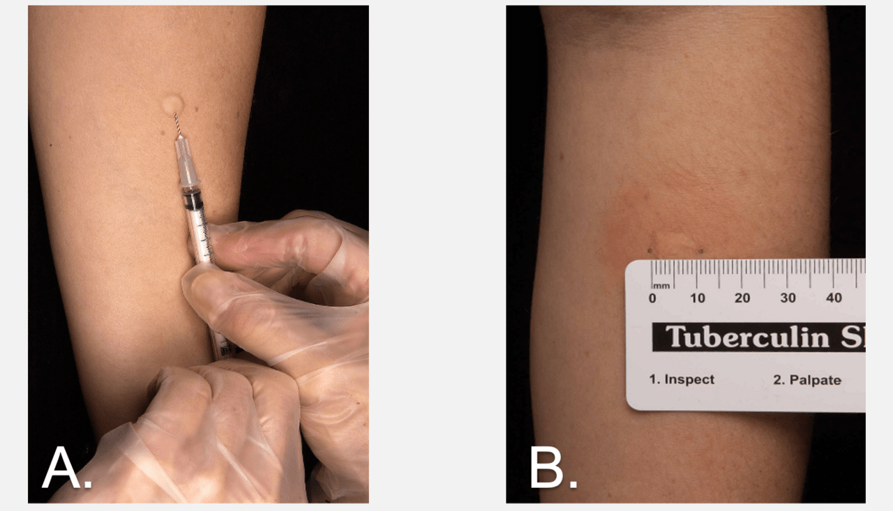 Core Concepts - Latent Tuberculosis Infection - Co-Occurring Conditions ...