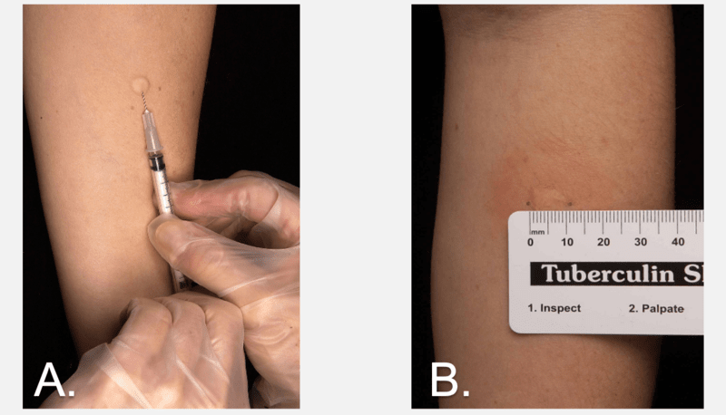 Core Concepts - Latent Tuberculosis Infection - Co-Occurring Conditions ...